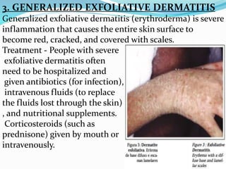 Exfoliative Dermatitis Causes Prevention Symptoms