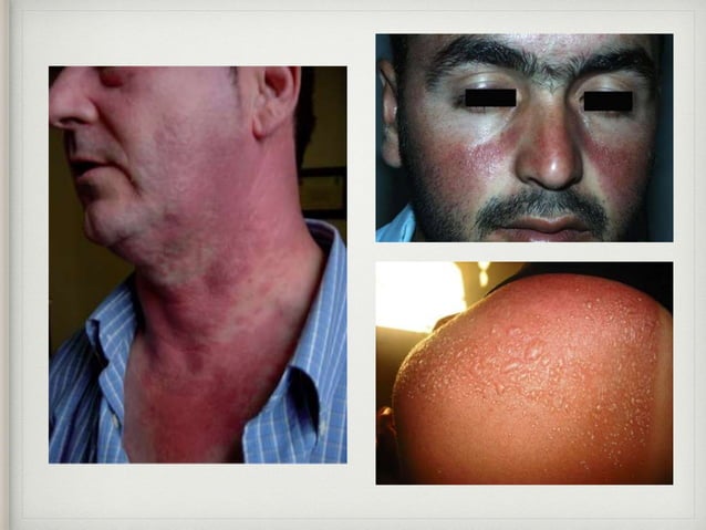 Dermatitis solar | PPTX | Skin and Dermatology | Diseases and Conditions