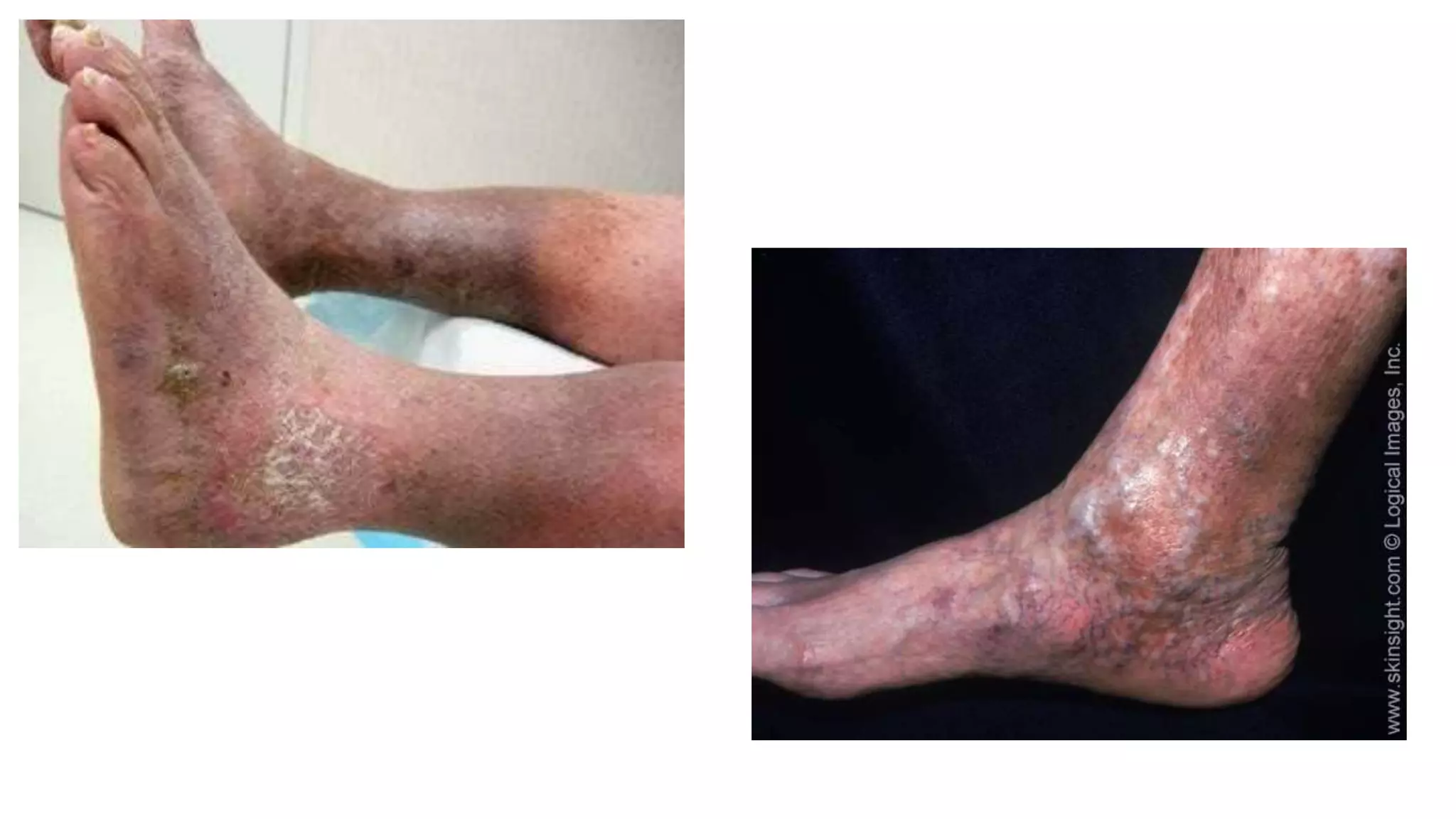 Dermatitis stasis | PPTX