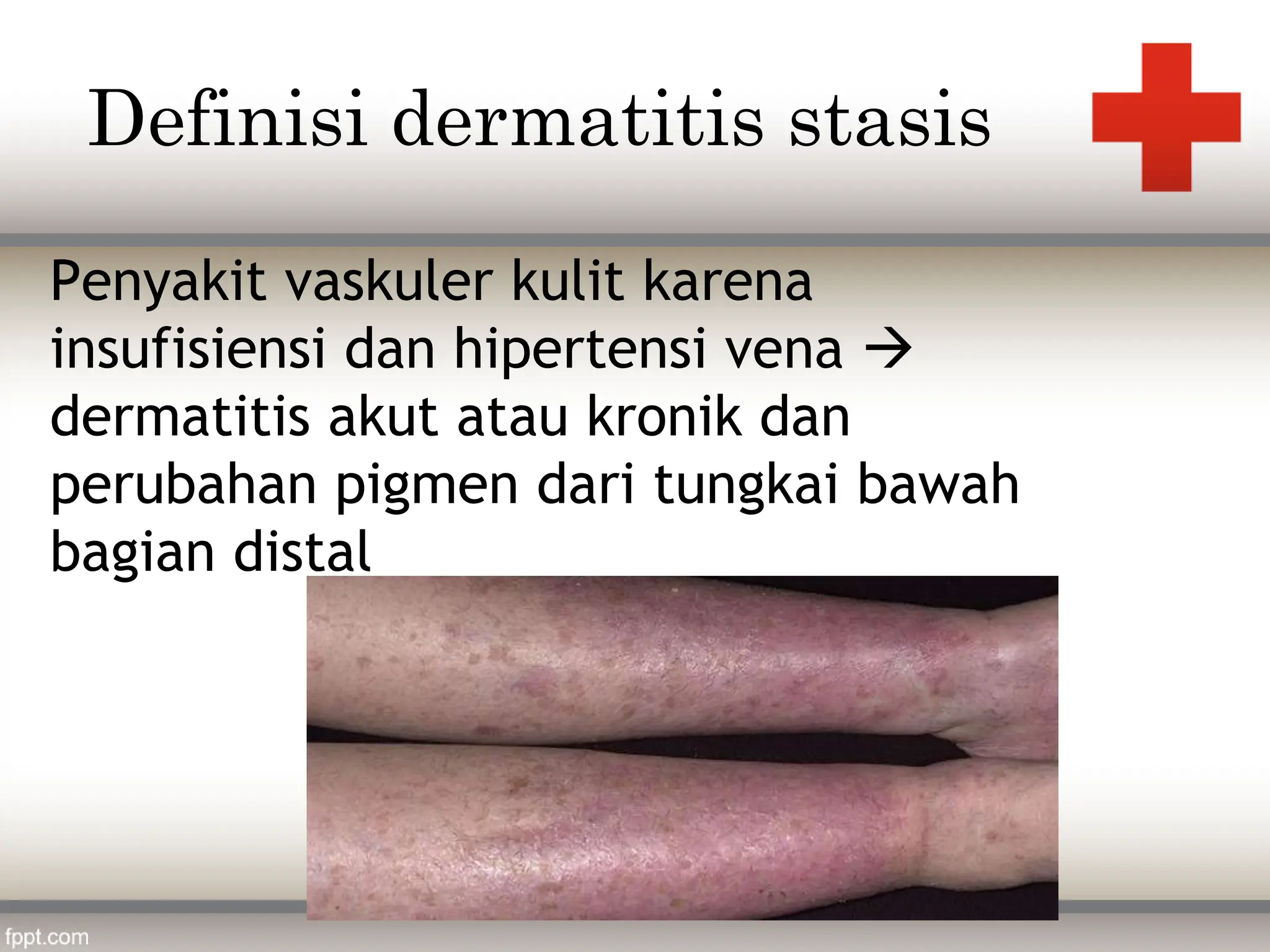 Dermatitis statis dermatitis statis dejj | PPTX