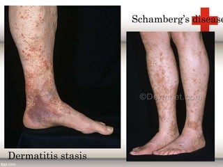 Dermatitis statis dermatitis statis dejj | PPTX
