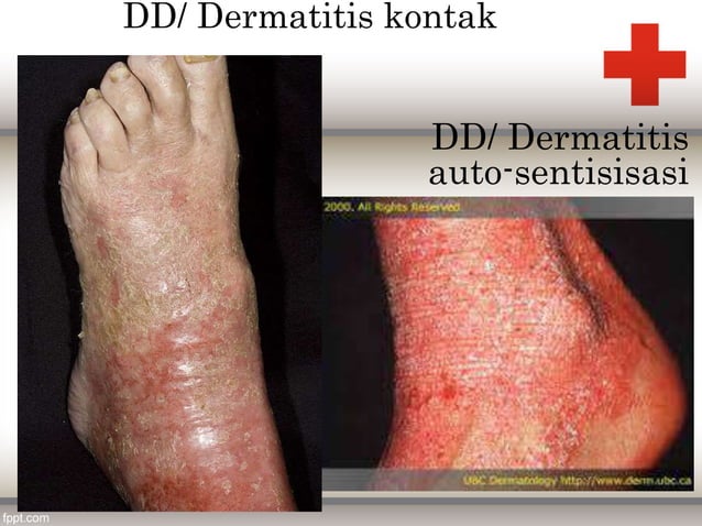 Dermatitis statis dermatitis statis dejj | PPT