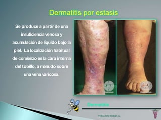 DERMATITIS, TIPOS Y TRATAMIENTOS.pptx