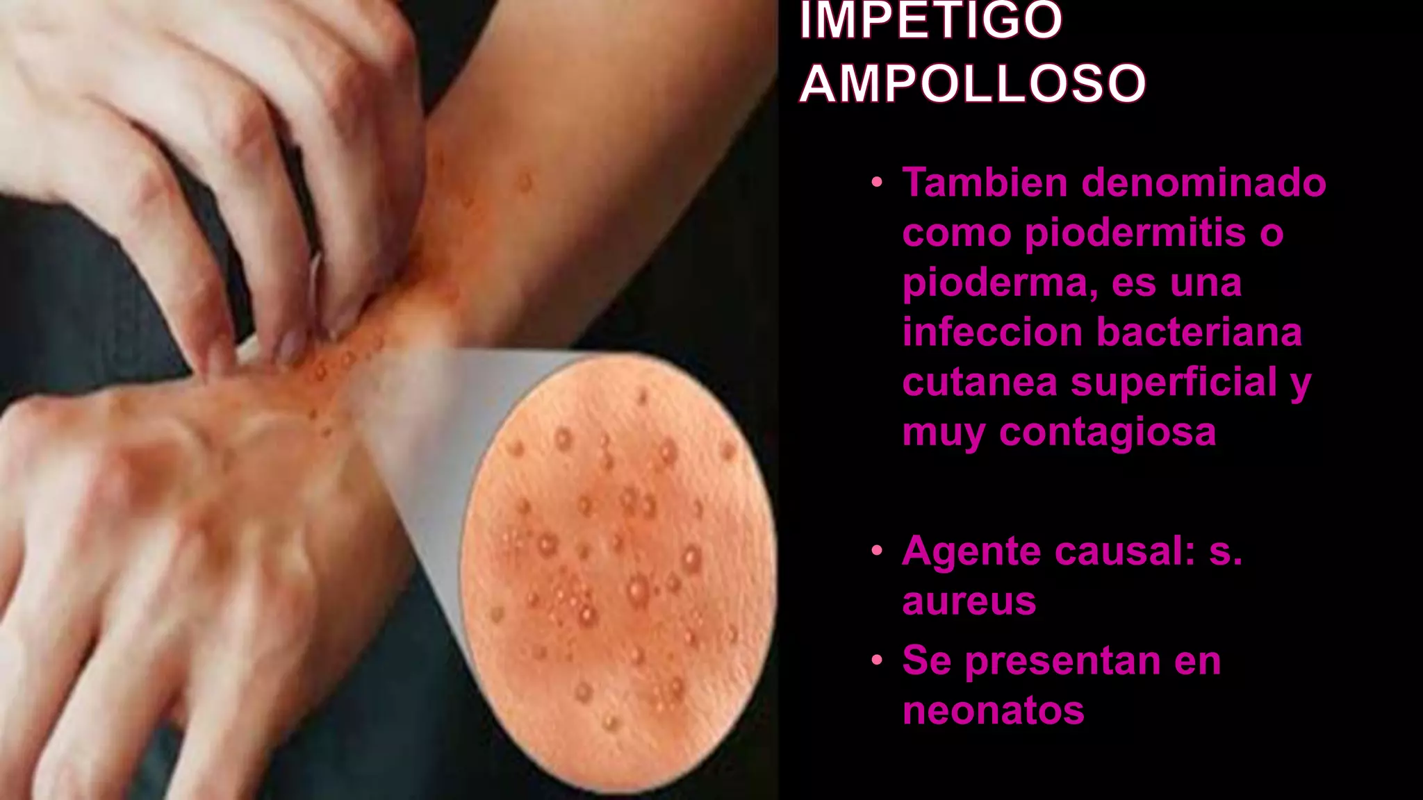PIODERMITIS PIODERMIAS DERMATOLOGIA | PPTX
