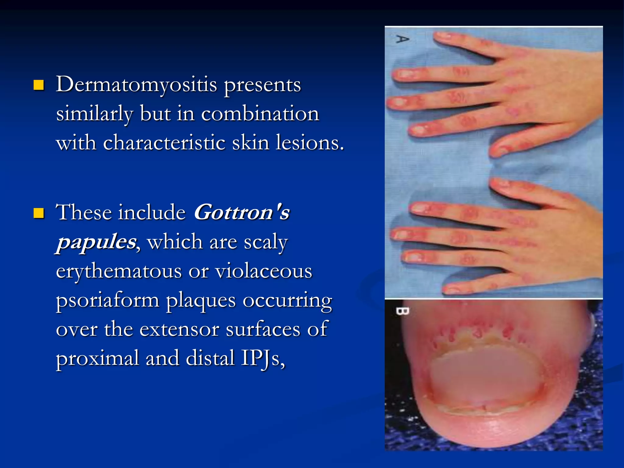 Dermatomyositis and Behcet's syndrome | PPT