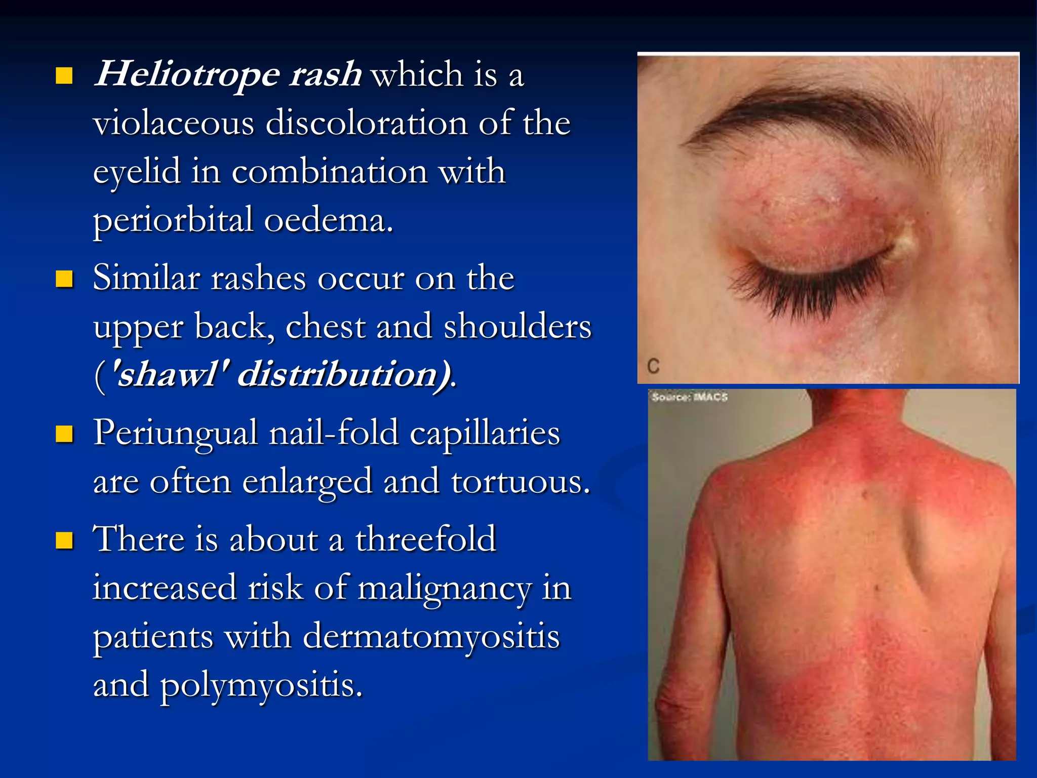 Dermatomyositis and Behcet's syndrome | PPT | Skin and Dermatology ...