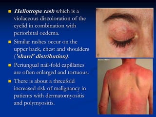 Dermatomyositis and Behcet's syndrome | PPT | Skin and Dermatology ...