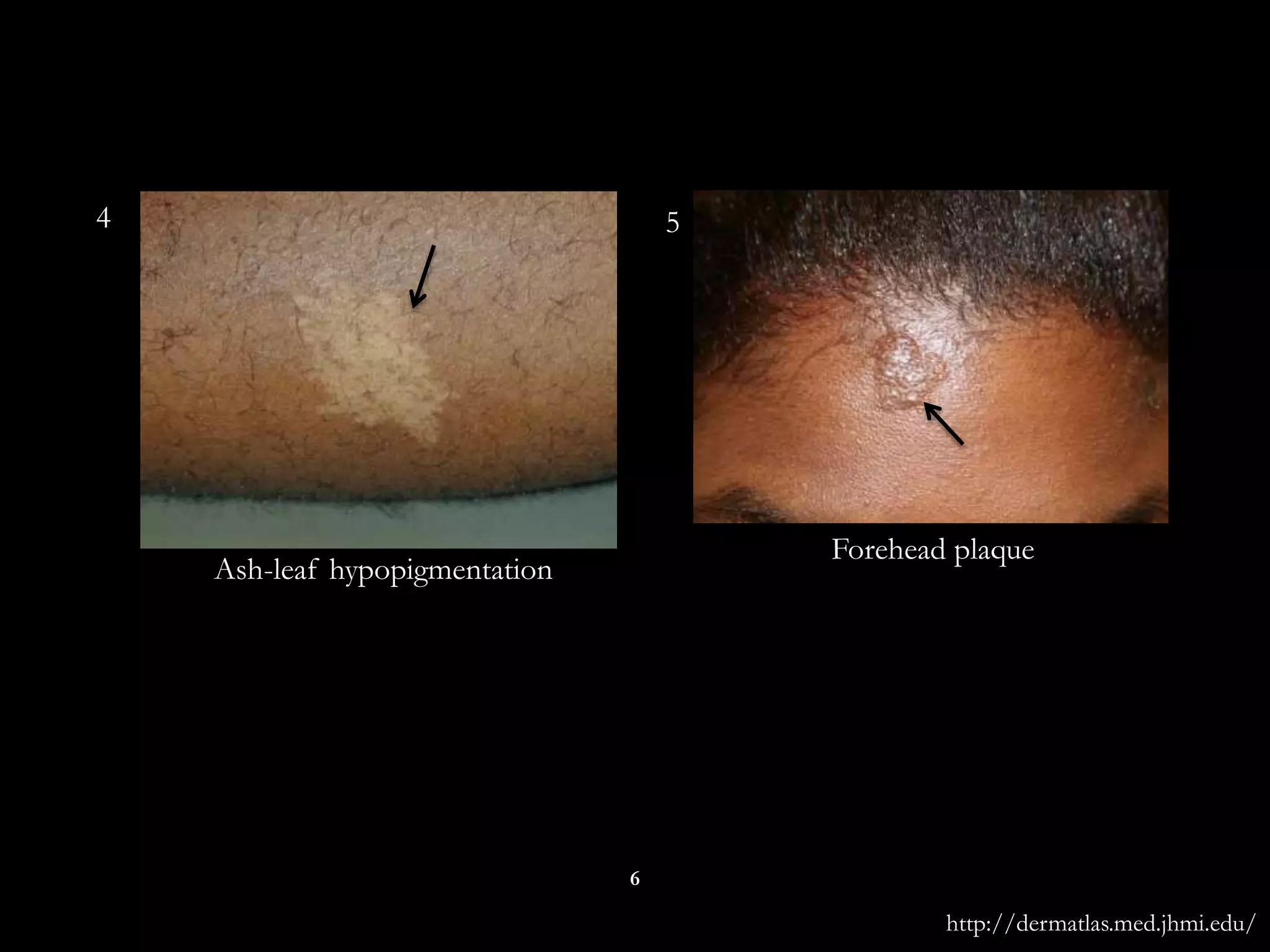 Dermatoly in neurology | PPTX