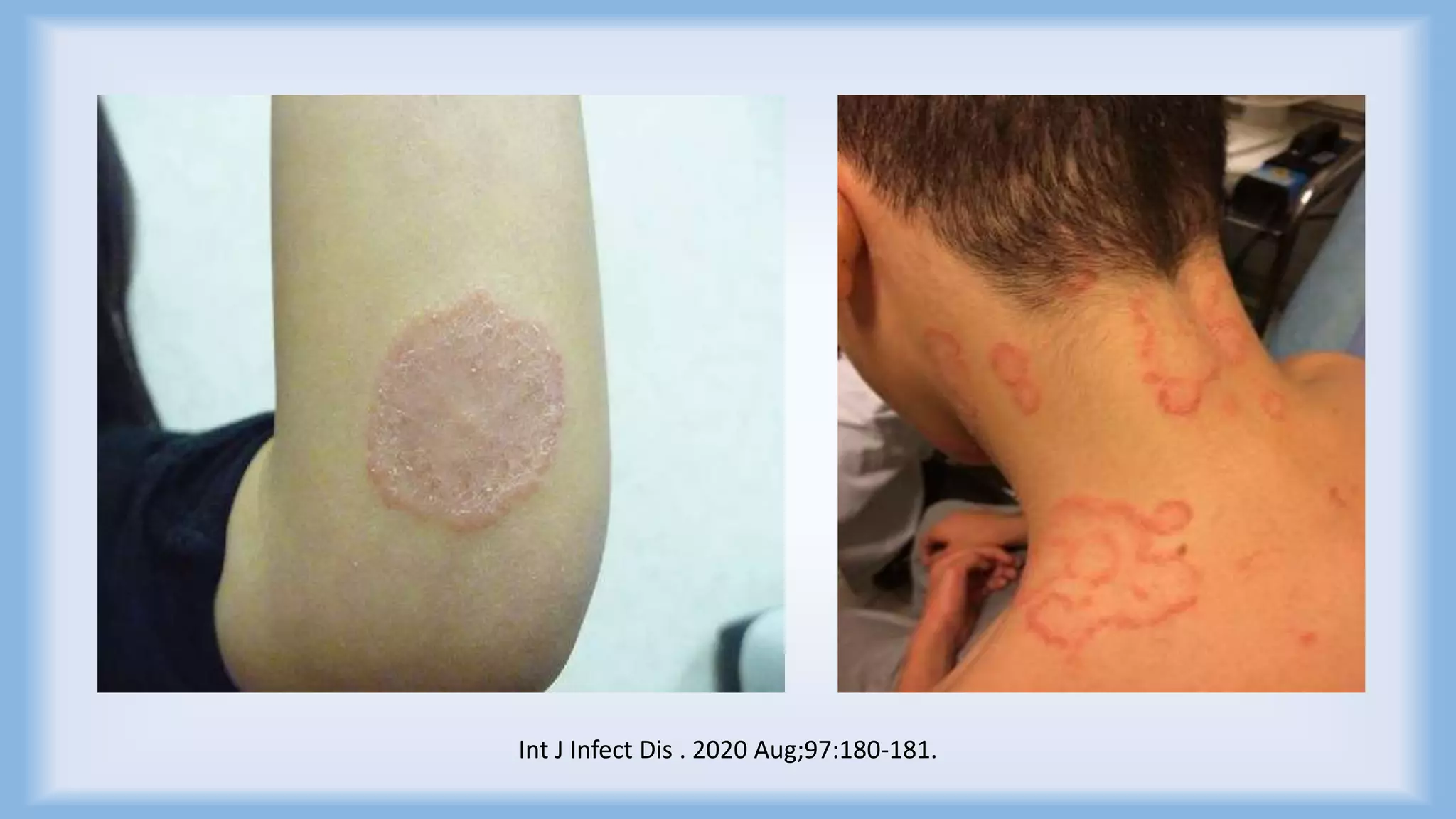 Dermatofitosis (Tiñas) | PPTX