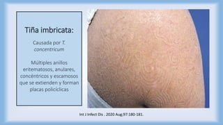 Dermatofitosis (Tiñas) | PPTX