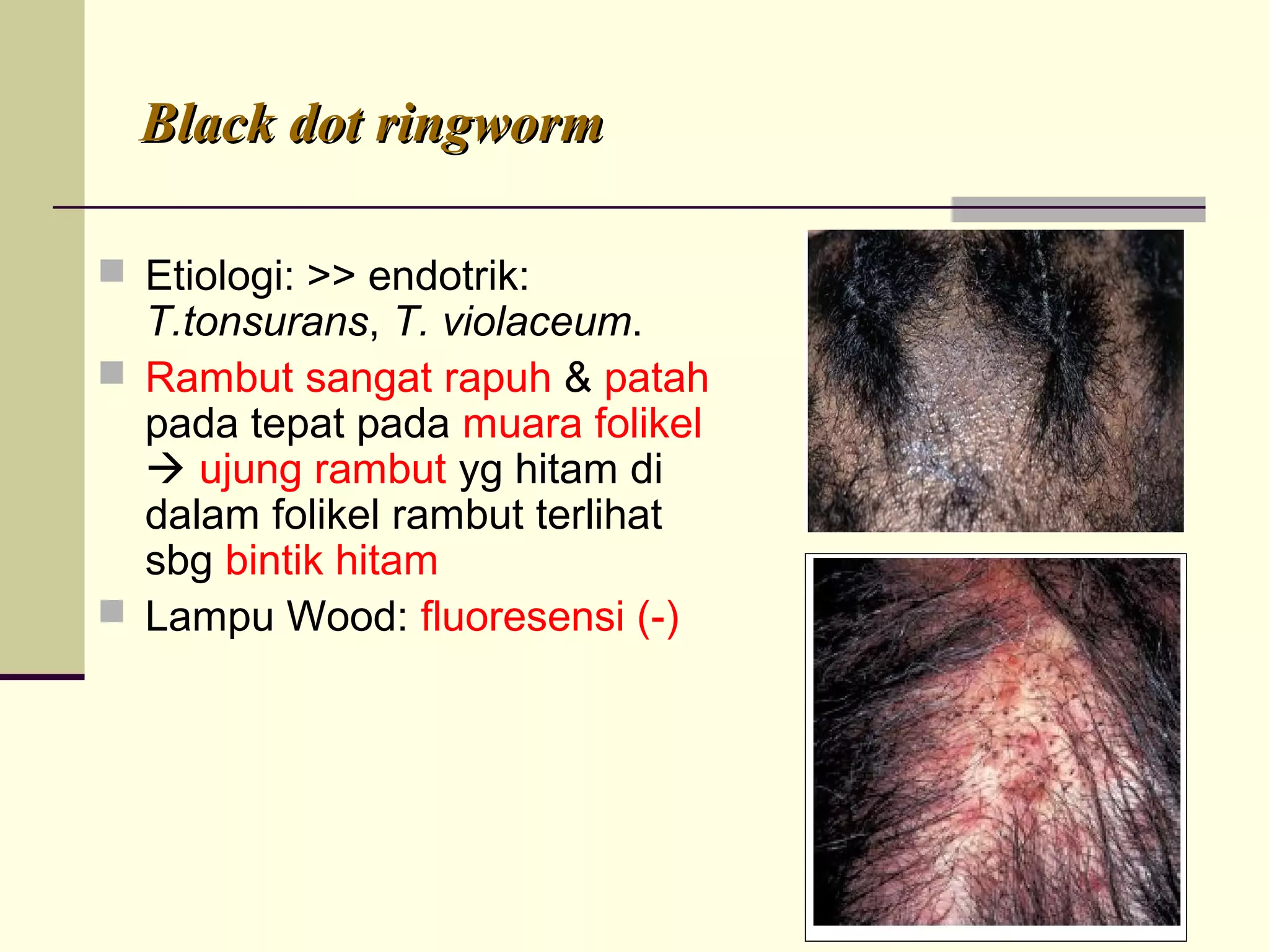 Dermatofitosis | PPT