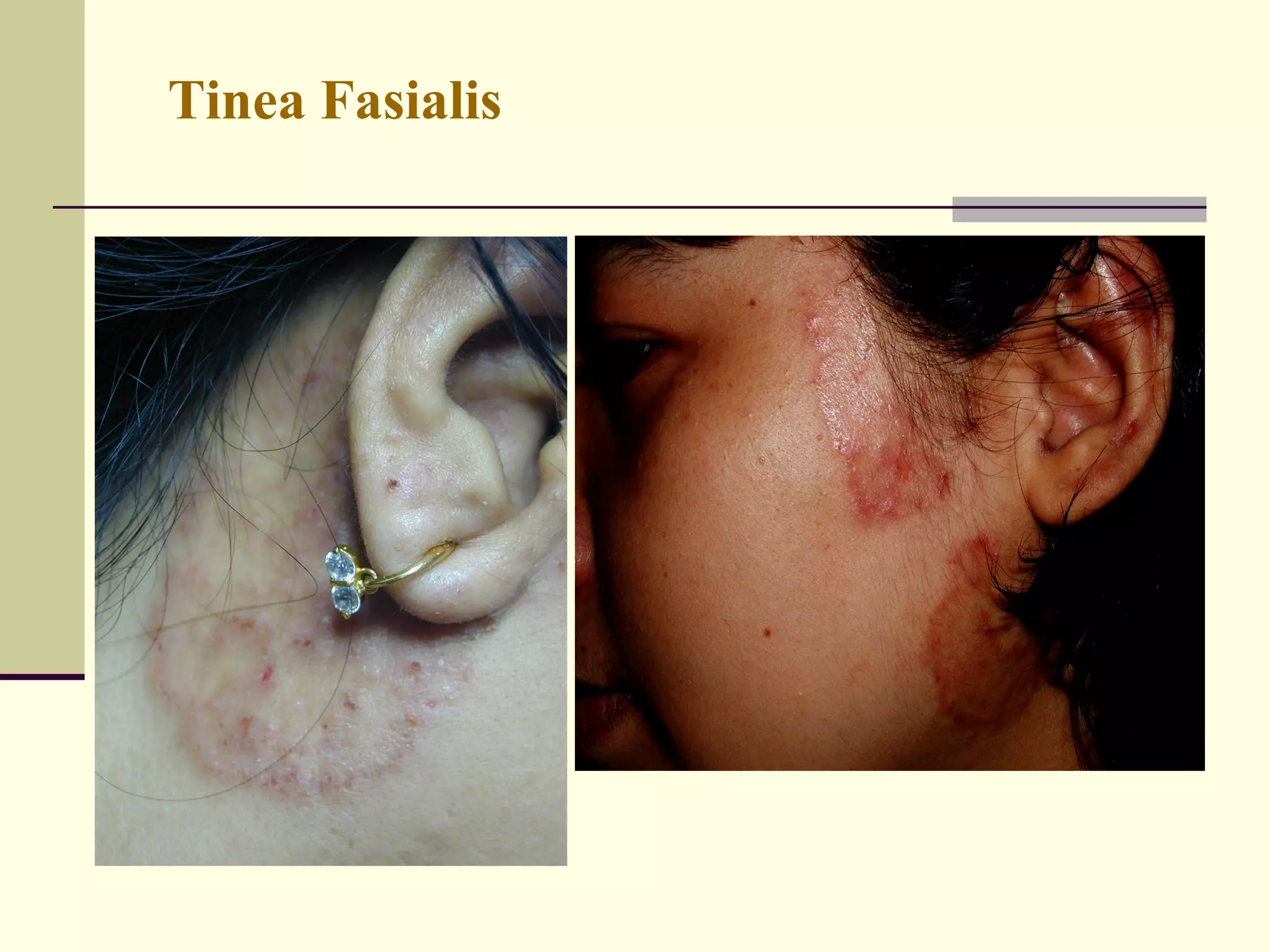 Dermatofitosis | PPT