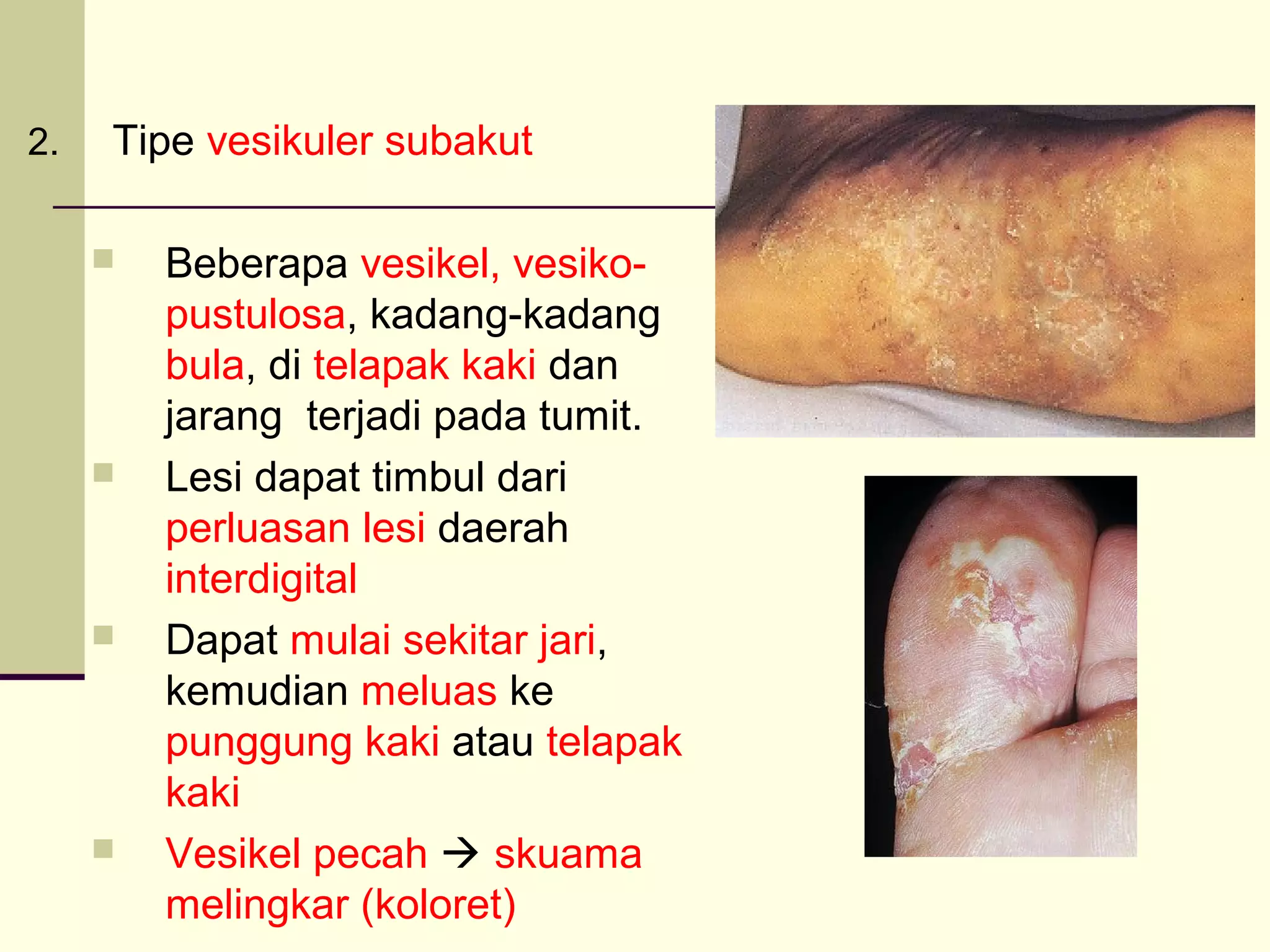 Dermatofitosis | PPT