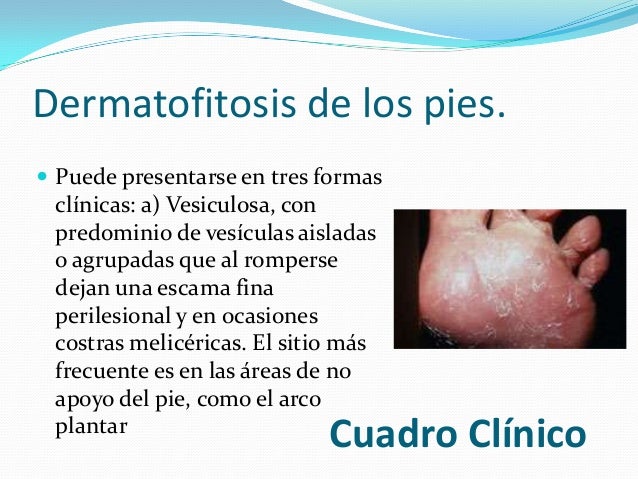 Dermatofitosis