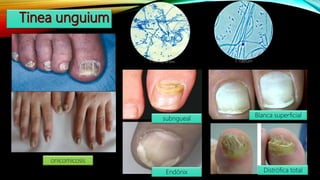 Dermatofitosis tviolaceum | PPTX