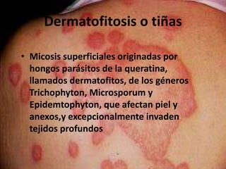 Dermatofitosis | PPTX