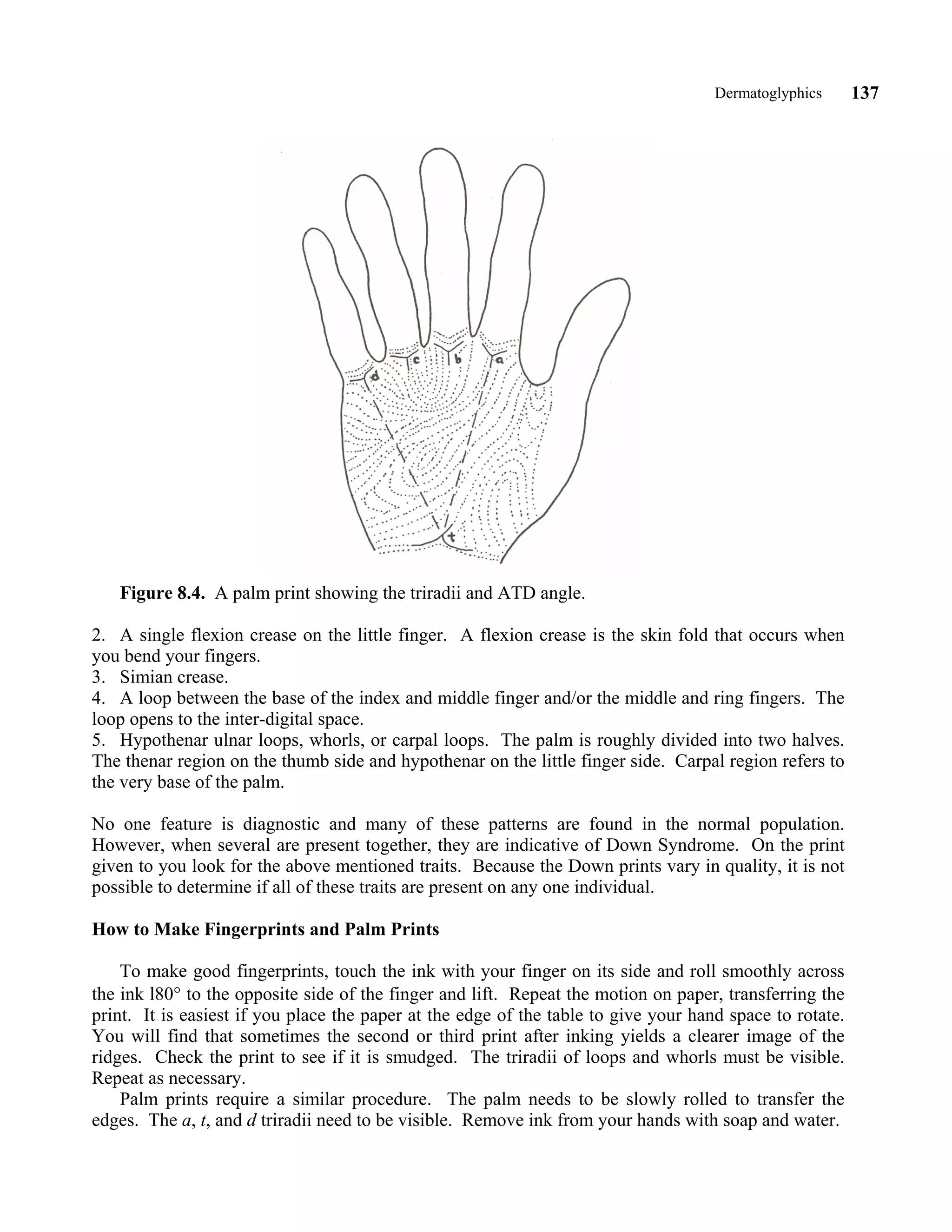 Dermatoglyphics with down | PDF