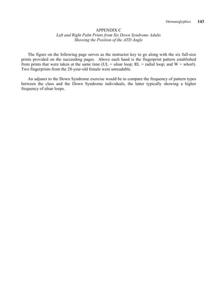 Dermatoglyphics with down | PDF