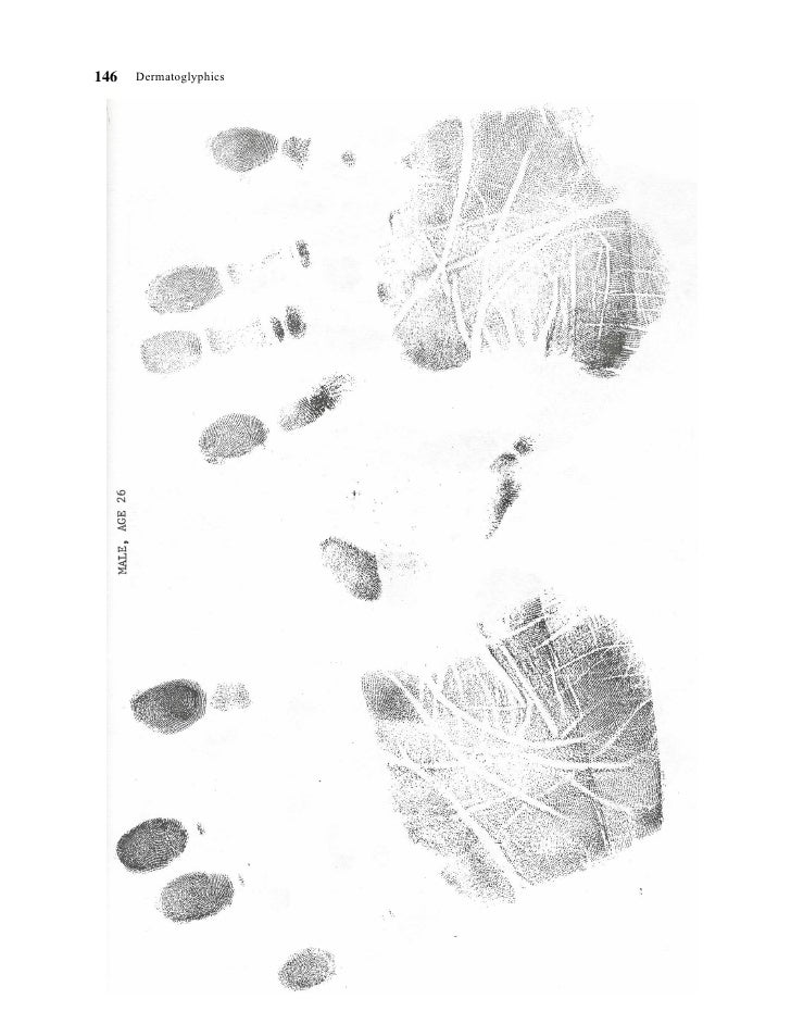 Dermatoglyphics with down