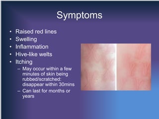 Dermatographia | PPT