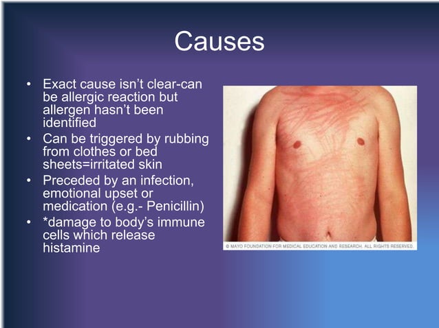 Dermatographia | PPTX | Skin and Dermatology | Diseases and Conditions