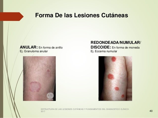 Lesiones Primarias y Secundarias de la Piel