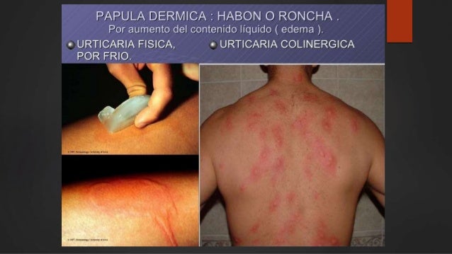 Dermatología lesiones elementales.