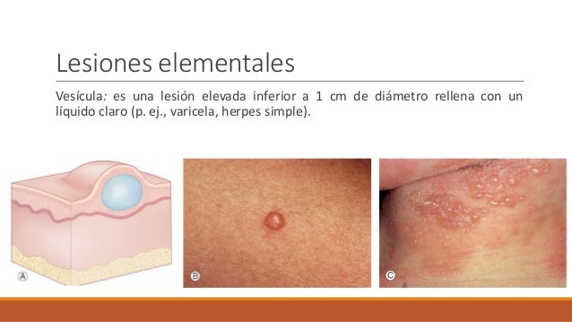 Dermatología hc y lesiones elementales