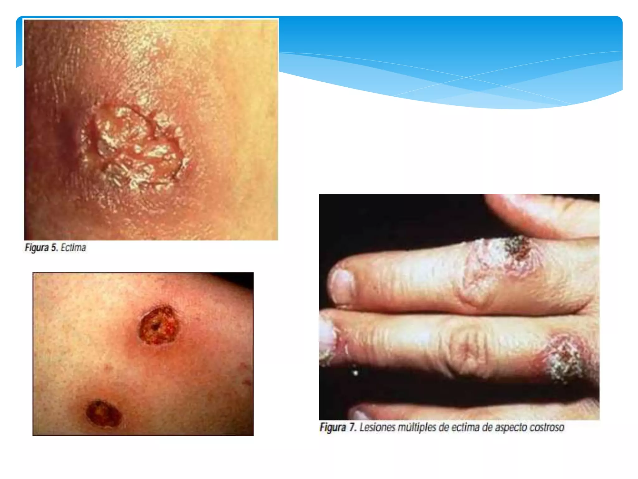 Dermatología piodermitis | PPTX
