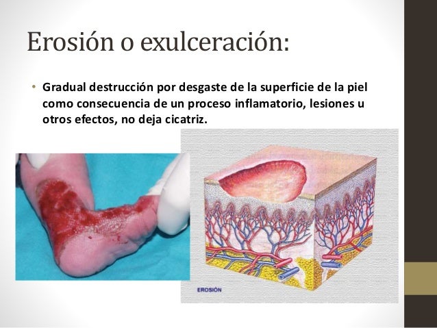 Dermatología (La Piel: Lesiones Elementales)