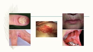 Dermatological changes in diabetes | PDF