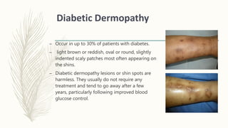 Dermatological changes in diabetes | PDF