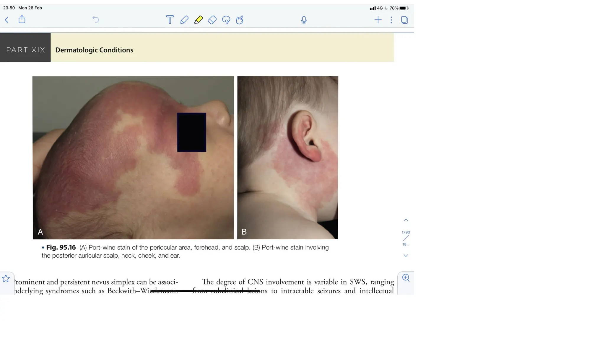 Dermatologic condition NB from NKP hospital | PPT