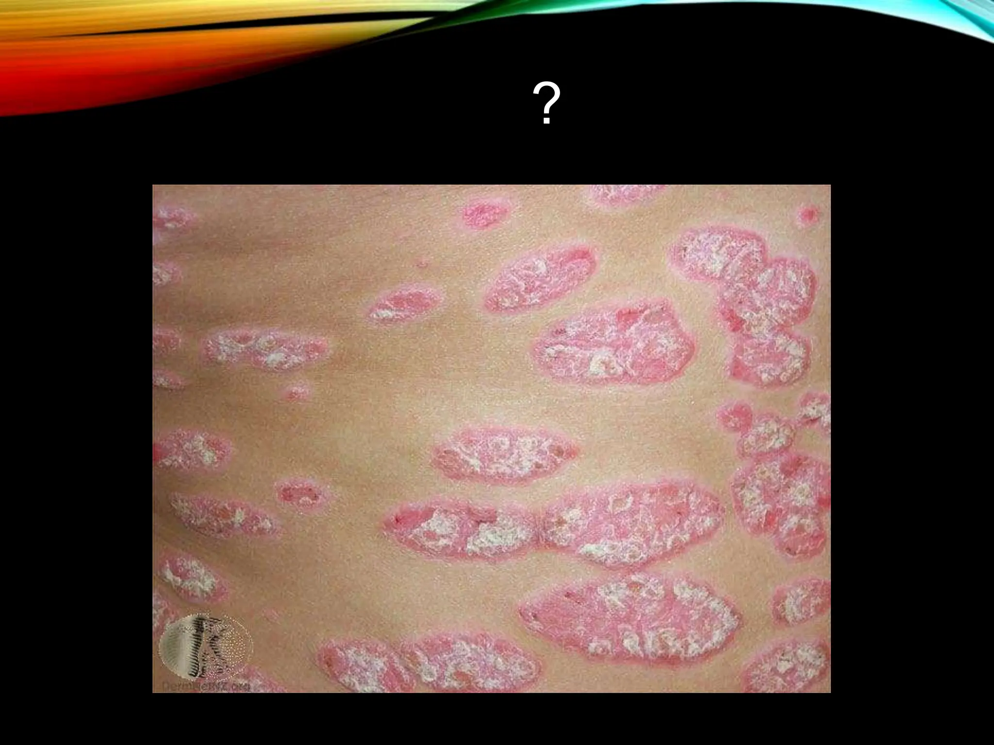 Dermatologic disorders commonly missed in the ED.pptx