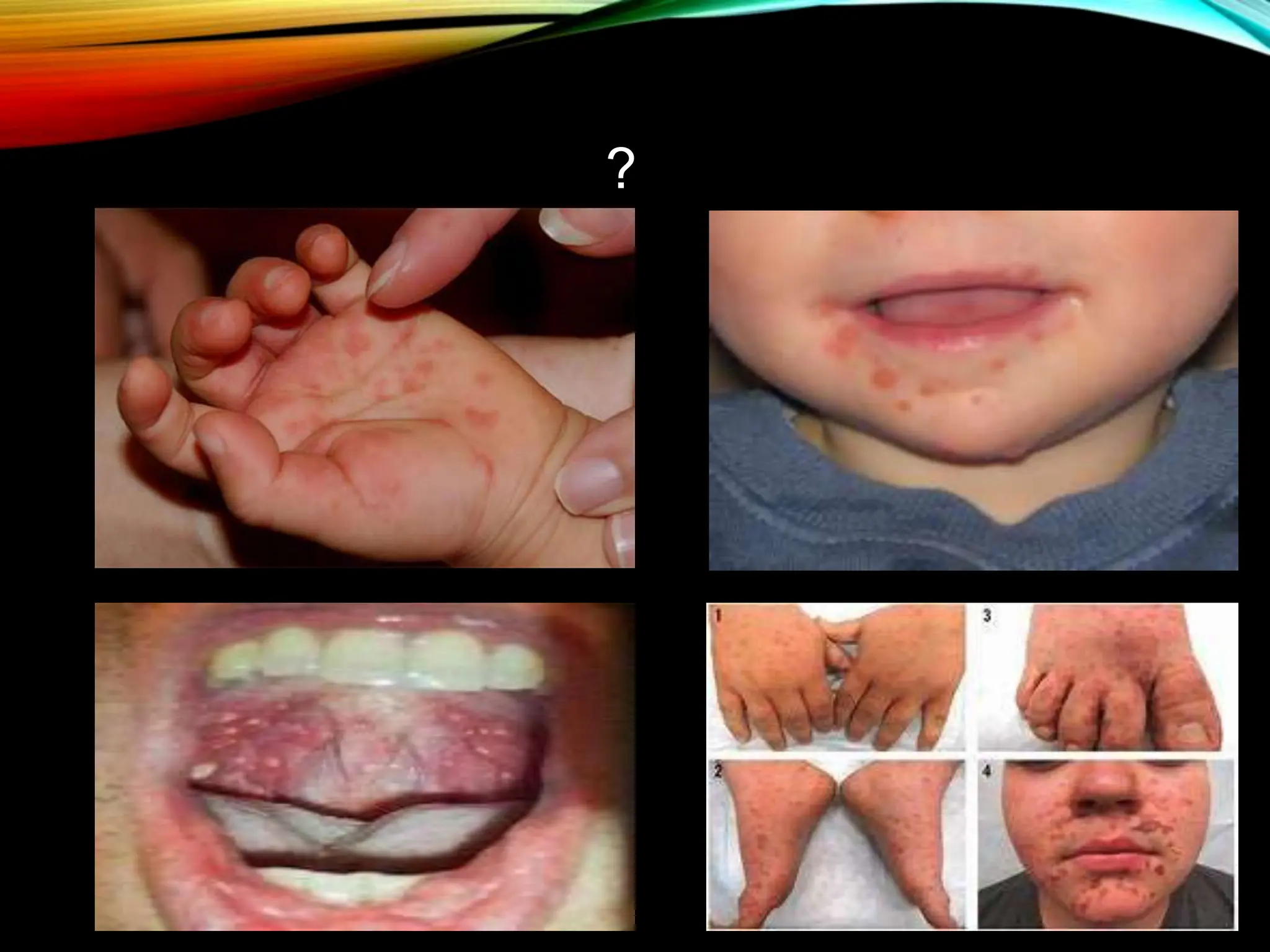 Dermatologic disorders commonly missed in the ED.pptx