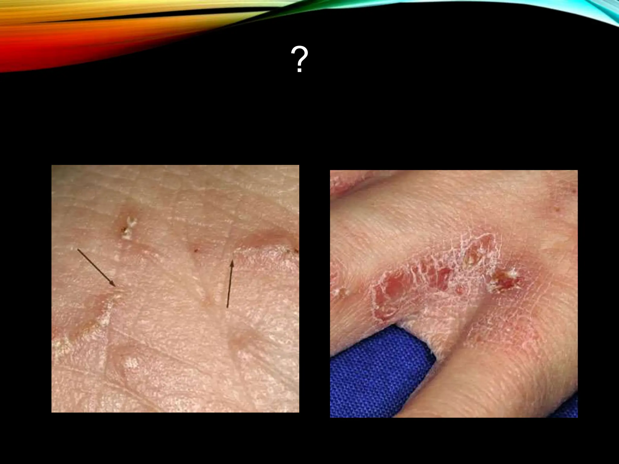 Dermatologic disorders commonly missed in the ED.pptx