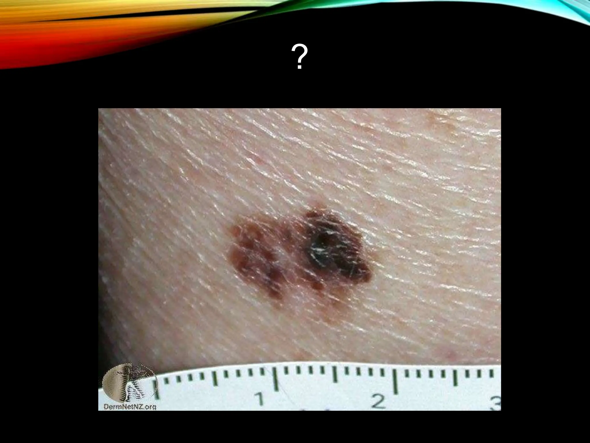 Dermatologic disorders commonly missed in the ED.pptx