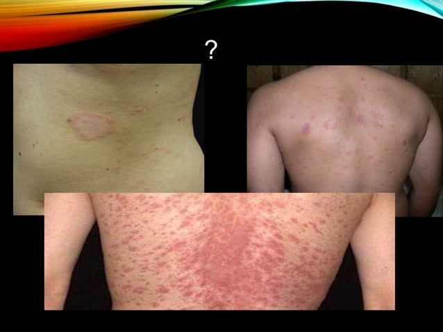 Dermatologic disorders commonly missed in the ED.pptx