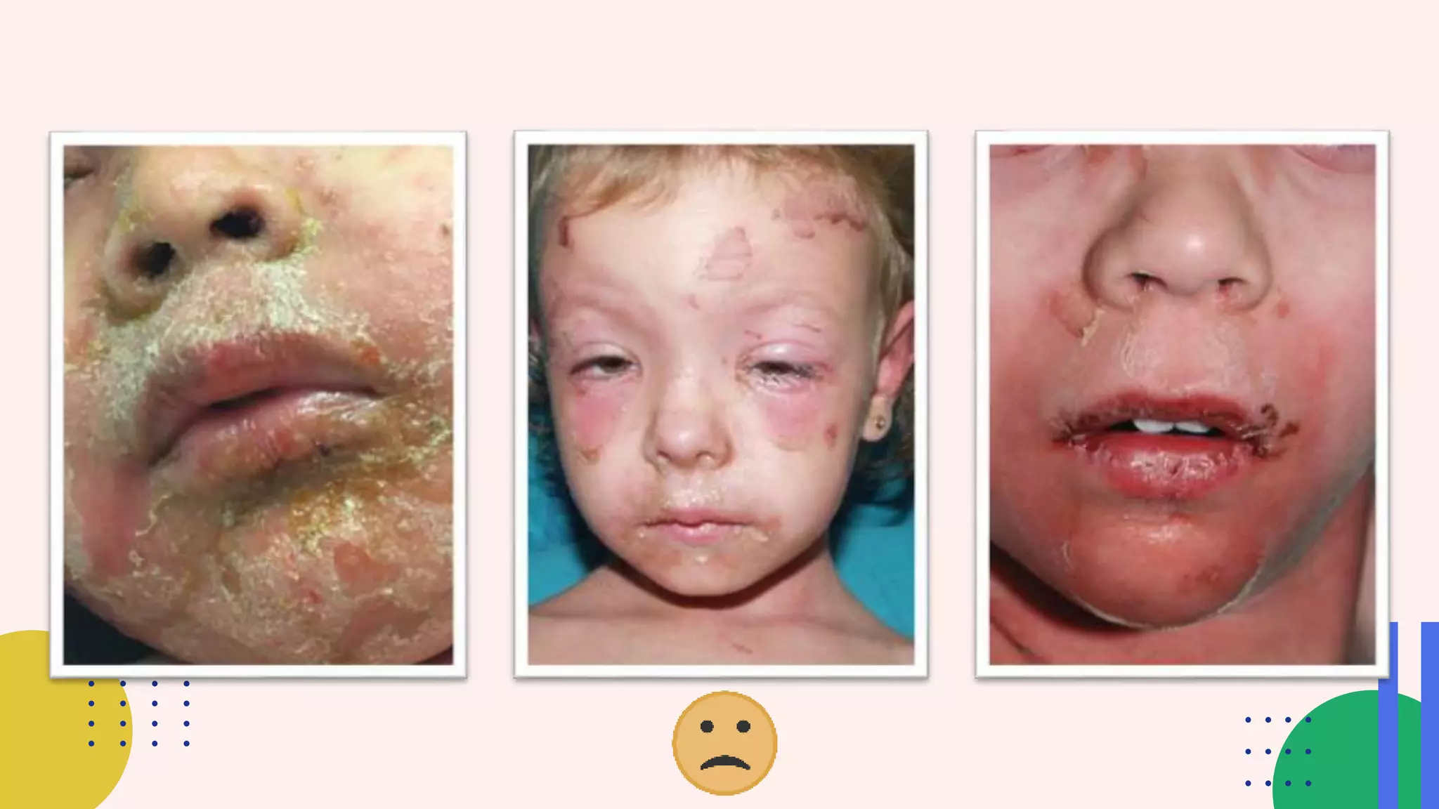 Dermatologic Emergencies in Children | PPTX