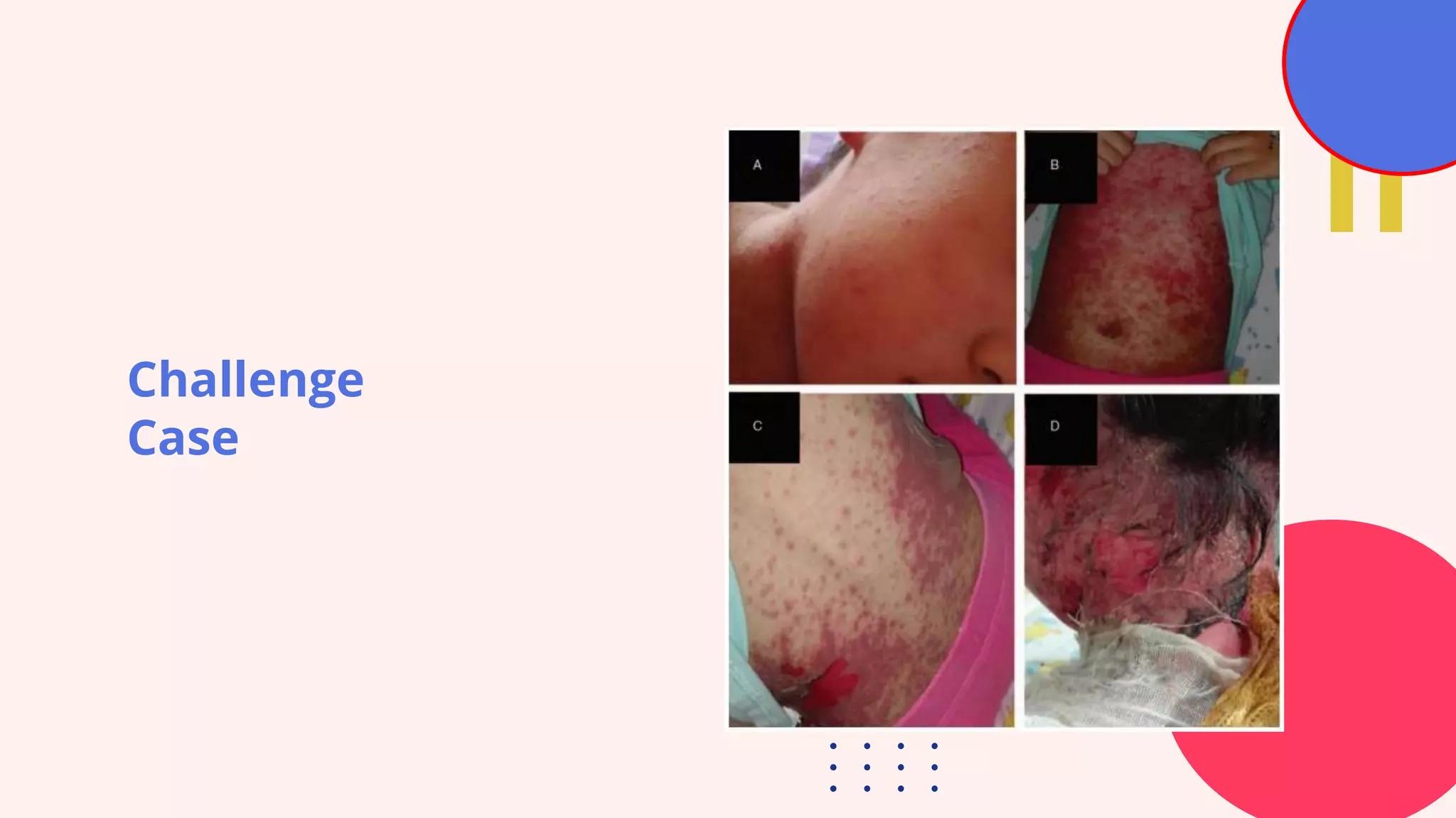 Dermatologic Emergencies in Children | PPTX