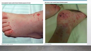 Dermatologic manifestations of renal diseases | PPTX