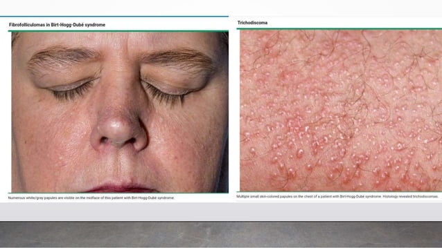 Dermatologic manifestations of renal diseases | PPTX | Blood Disorders ...