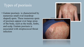 dermatology - Psoriasis | PPTX | Skin and Dermatology | Diseases and ...