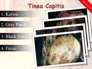 (Dermatology) fungal infections in pashto language by dr. kalimullah ...