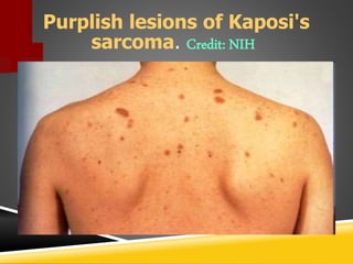 Dermatology(kaposis sarcoma) | PPTX