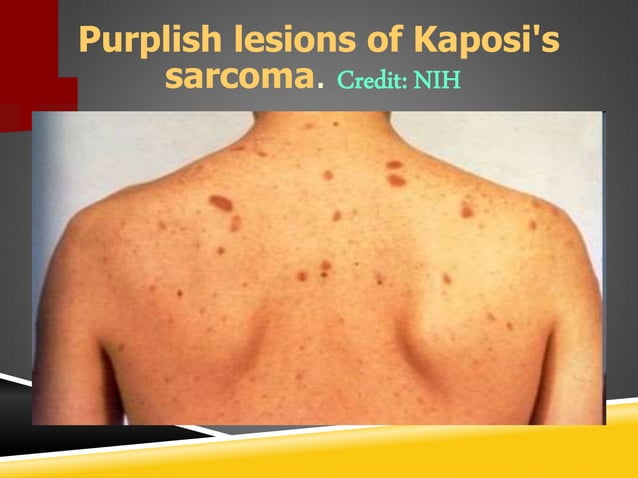 Dermatology(kaposis sarcoma) | PPTX
