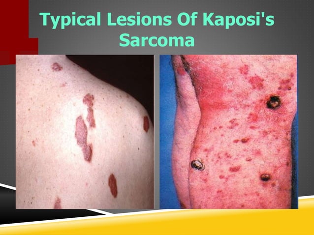 Dermatology(kaposis sarcoma) | PPTX
