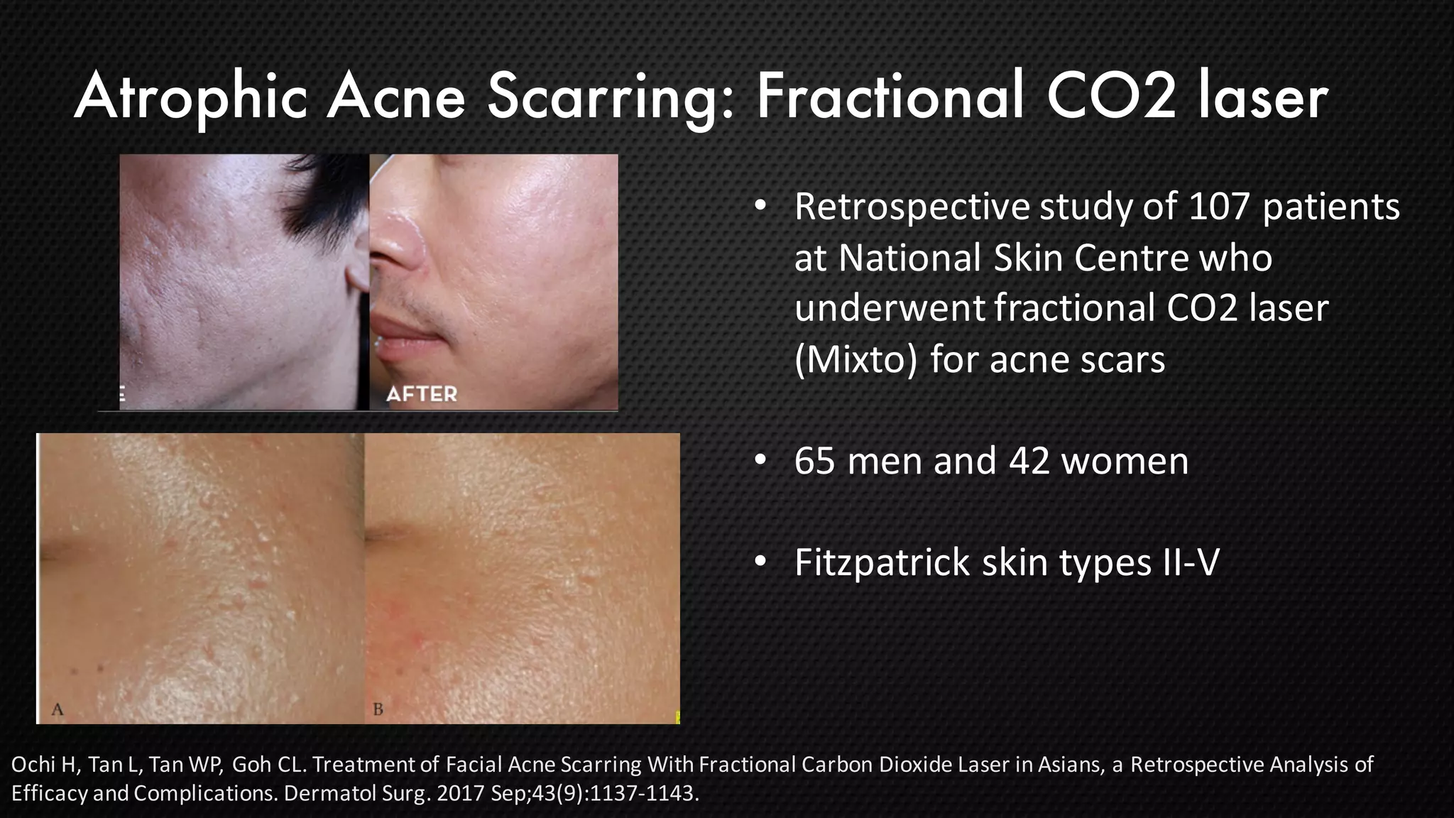 Laser in Asian Skin | PDF