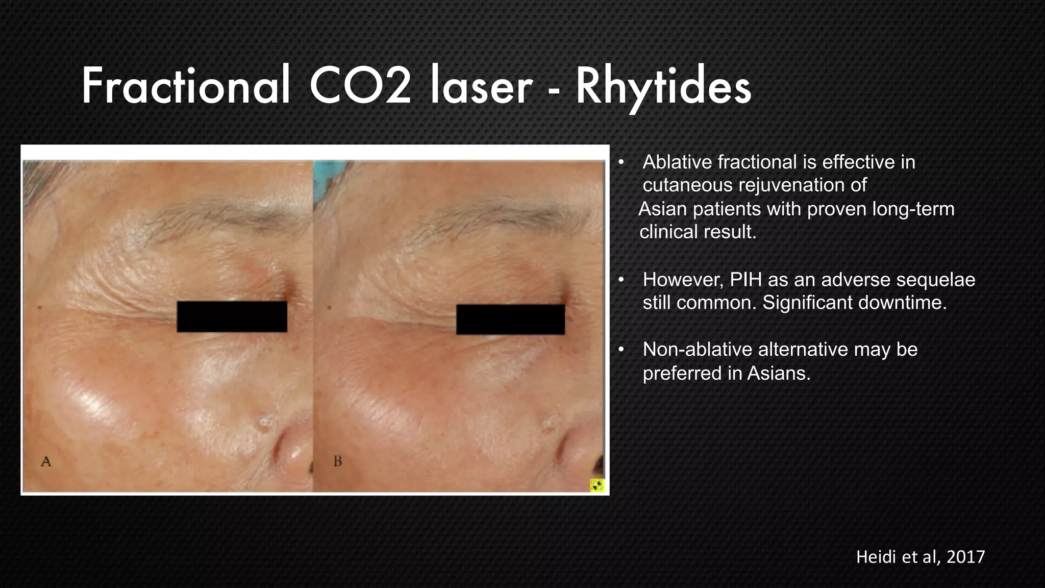 Laser in Asian Skin | PDF