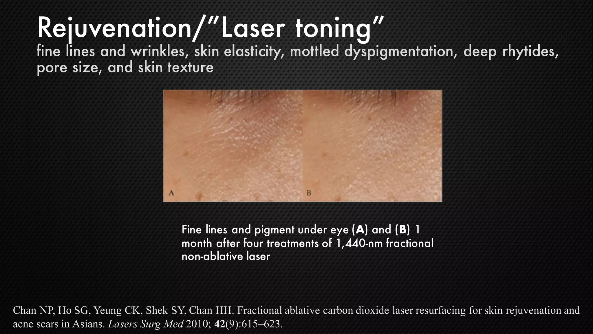 Laser in Asian Skin | PDF
